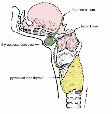 Thyroglossal Duct Cyst - Endocrine - Medbullets Step 1