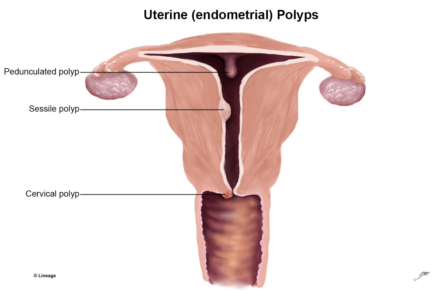 Endometrial Polyp Reproductive Medbullets Step 1