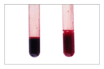 Methemoglobinemia - Hematology - Medbullets Step 1