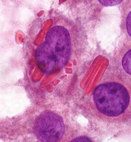 Ovarian Tumors - Oncology - Medbullets Step 1