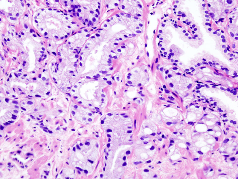 Prostatic Adenocarcinoma - Oncology - Medbullets Step 1