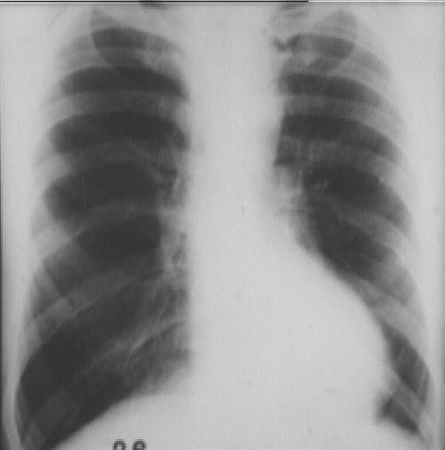 Coarctation of Aorta - Cardiovascular - Medbullets Step 2/3