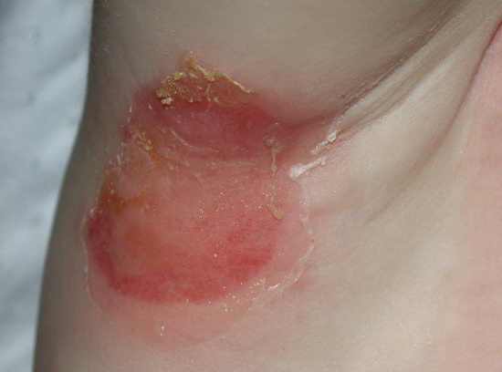 Impetigo - Dermatology - Medbullets Step 2/3