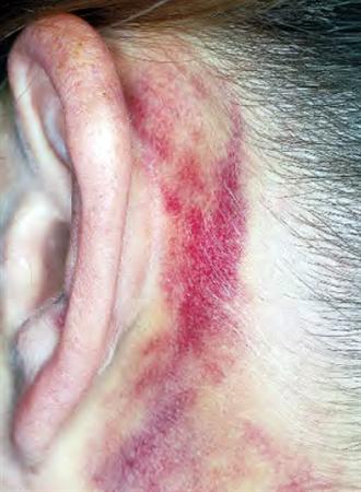 Basilar Skull Fracture - Neurology - Medbullets Step 2/3