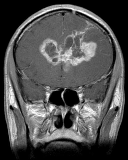 Glioblastoma - Oncology - Medbullets Step 2/3