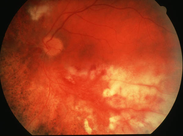 Cytomegalovirus (CMV) - Infectious Dis. - Medbullets Step 2/3