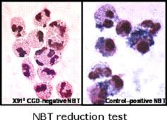 Chronic Granulomatous Disease of Childhood (CGD) - Pediatrics ...