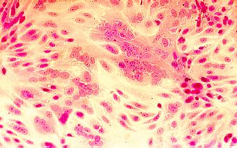 RSV - Microbiology - Medbullets Step 1