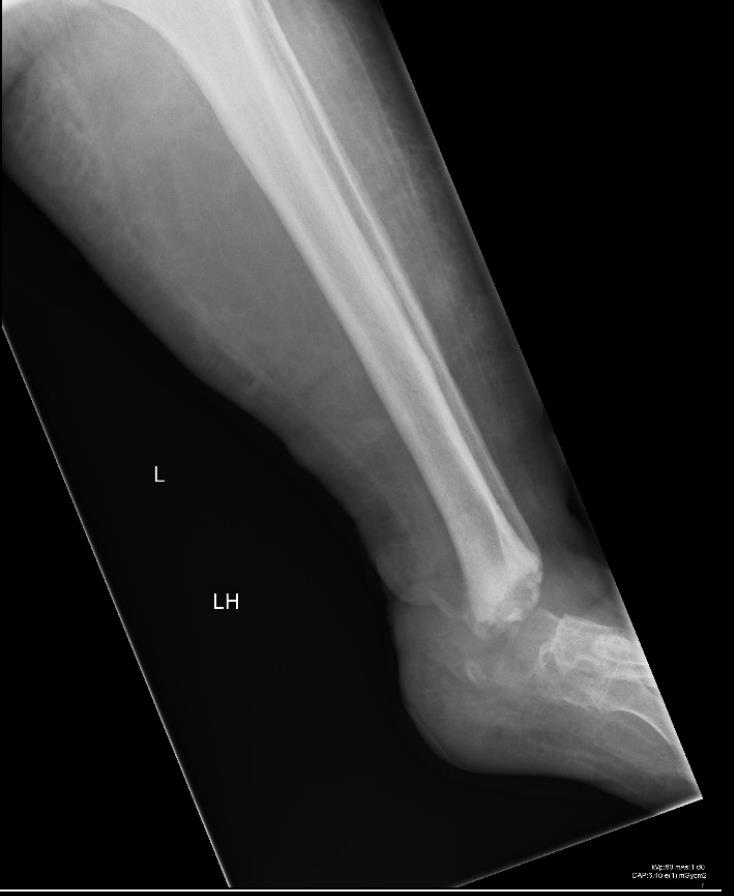 Neuropathic (Charcot) Arthropathy - Orthopedics - Medbullets Step 2/3